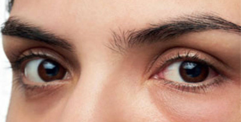Why Do I Get Swollen Eyes in the Morning? Causes & Treatments