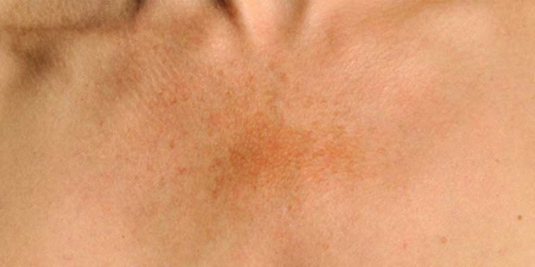 Dark Armpit | Get Rid of Dark Underarms | Easy Remedies