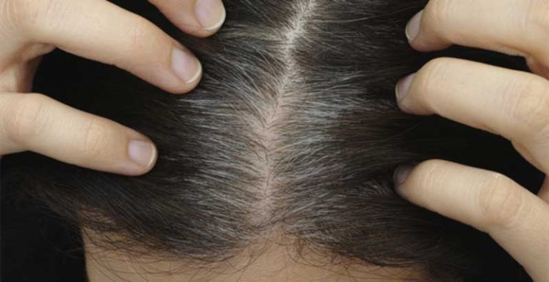 Stress Leads To Grey Hair - Here's How To Manage It