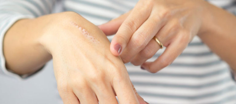 How to Get Rid of Burn Scars and Marks at Home