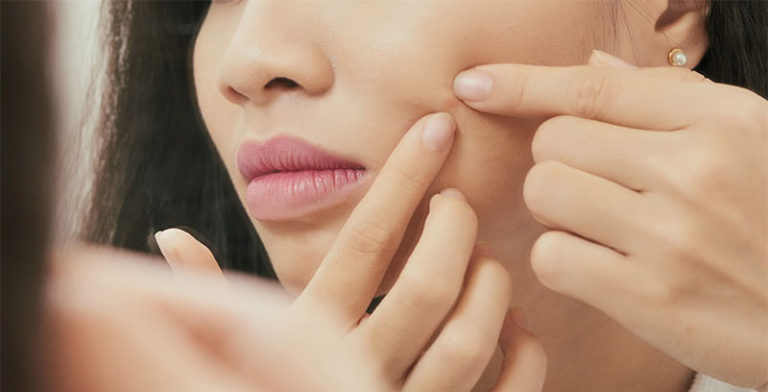 What To Do After Popping A Pimple – Everything You Need To Know