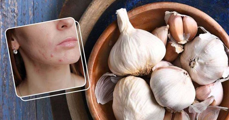 Garlic for Acne | Does Garlic Help Acne?